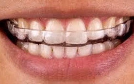 Splints - Mandibular Advancement Splints (MAS) for Teenagers