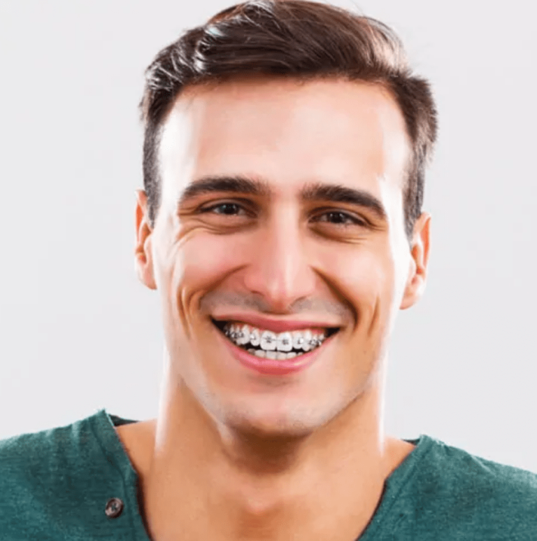 Benefits of Getting Braces as an Adult - Mehta Orthodontics