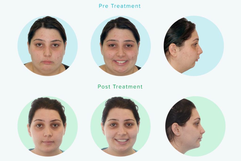 Jaw Surgery Sydney | Jaw Alignment Surgery Sydney