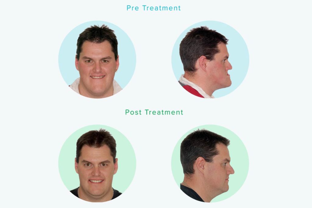 Jaw Surgery Sydney | Jaw Alignment Surgery Sydney