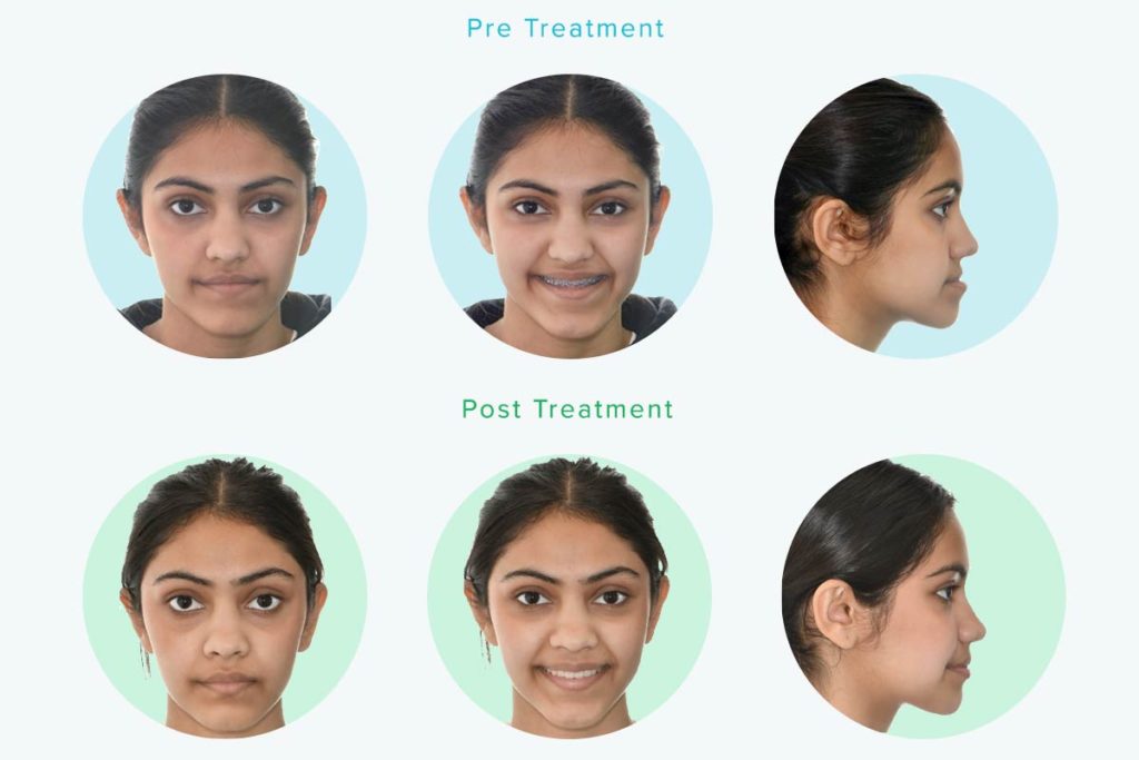 Jaw Alignment for Teenagers - Mehta Orthodontics